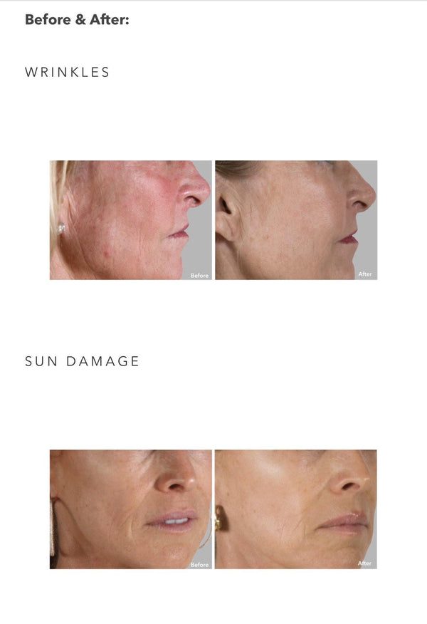 Ante Age MD Step 1 And 2 System - Skin & Brows by Tina